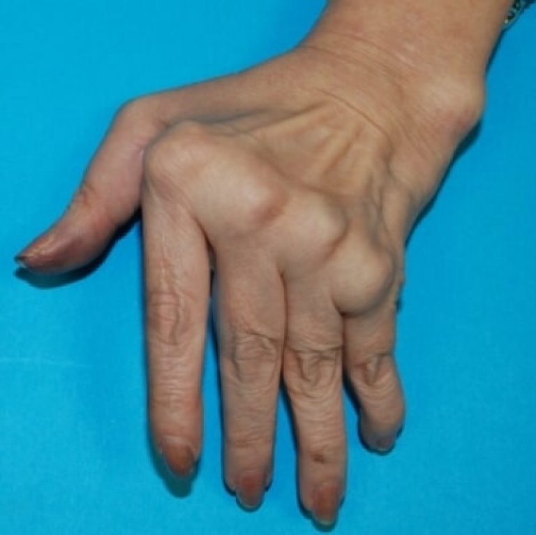 Deformities Of The Hand Hand Surgery Associates