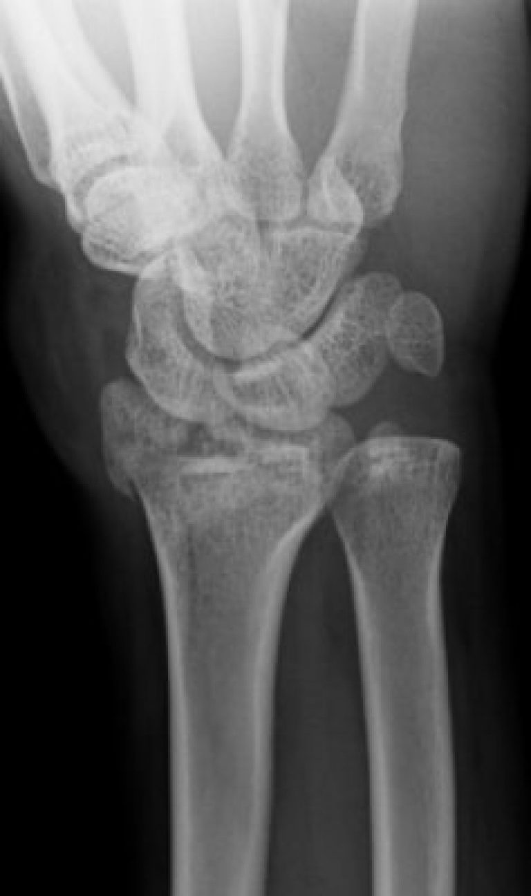 Distal Radius Fracture Treatment | Hand Surgery Associates