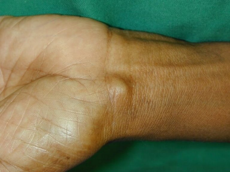 Hand Ganglion Treatment & Removal | Hand Surgery Associates