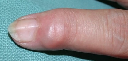 Synovial Cyst Finger Joint