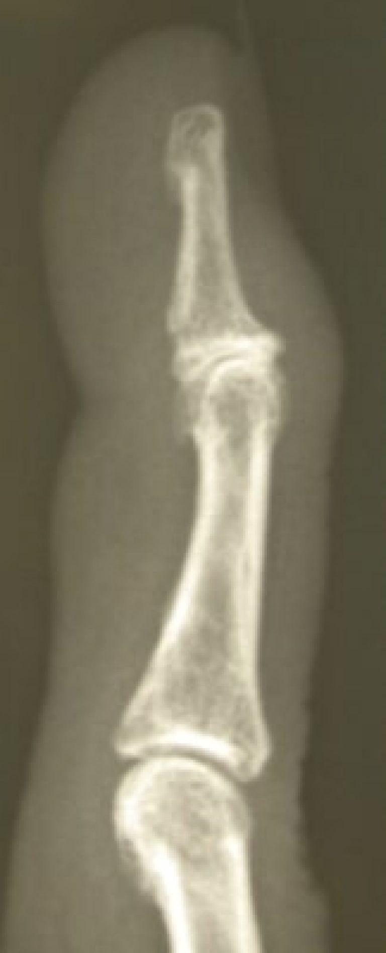 Hand Ganglion Treatment & Removal | Hand Surgery Associates