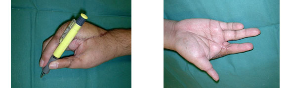 Hand Reconstruction Surgery | Hand Surgery Associates