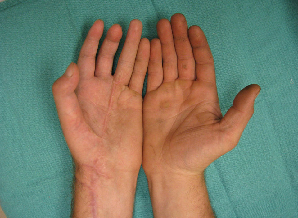 Hand Reconstruction Surgery | Hand Surgery Associates