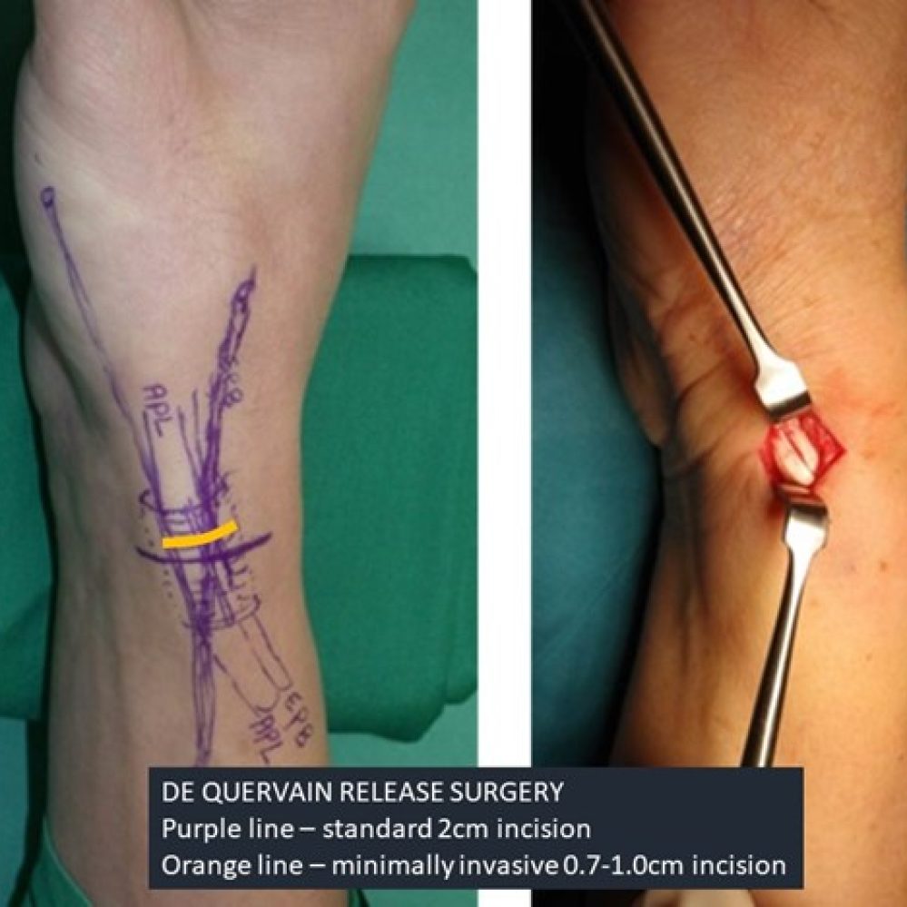DeQuervain’s Tenosynovitis | Hand Surgery Associates