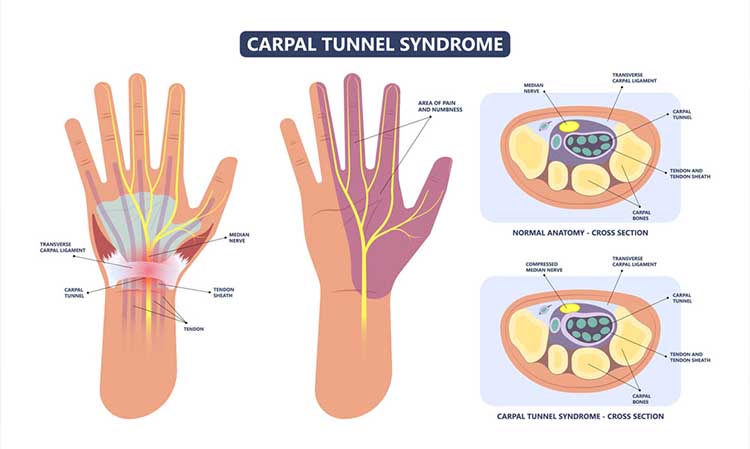 Carpal Tunnel Syndrome Treatment And Surgery In Sg Hsa